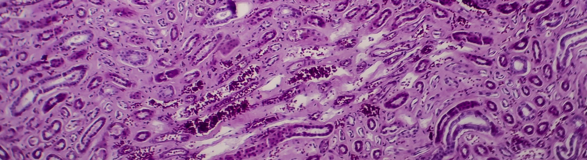Course: SLE: The joints and other organ involvement in SLE